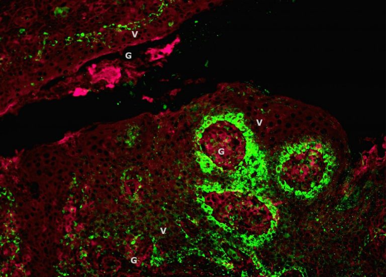 Biofilms in tonsil crypts may explain HPV-related head and neck cancers ...
